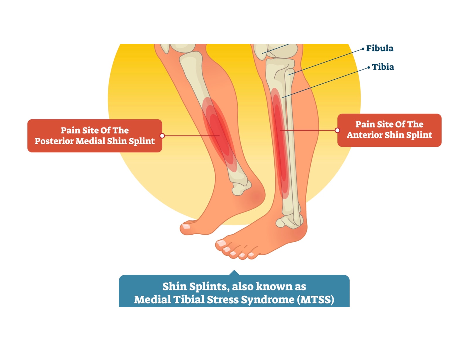 Last van je scheenbeen tijdens het sporten? - Van Rein Instituut B.V.